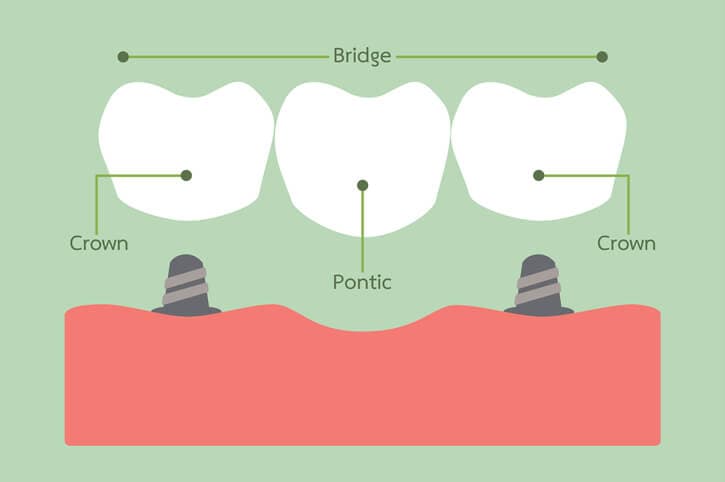 Crown and Bridge Treatment | Bayswater Dentist