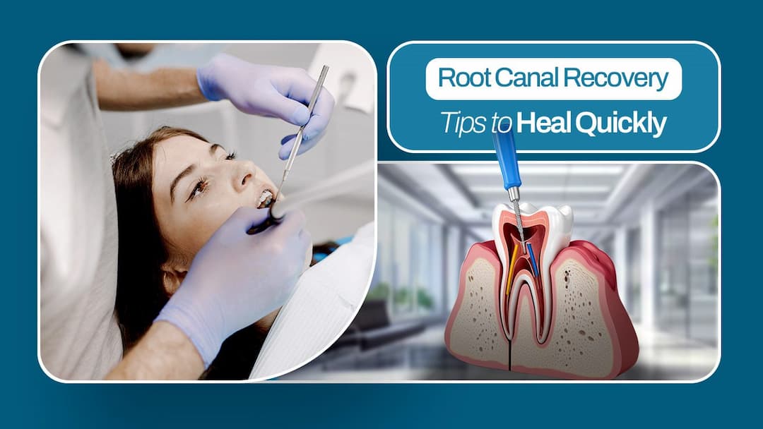 Root Canal Recovery Tips for Fast, Pain-Free Healing