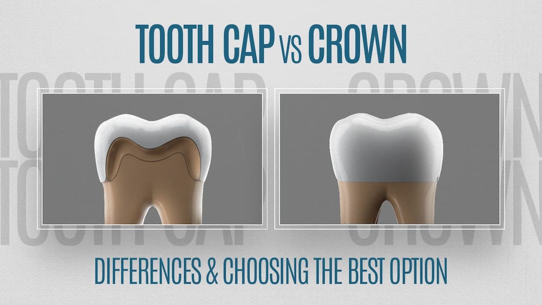 Tooth Cap vs Crown: Choosing the Best Dental Option